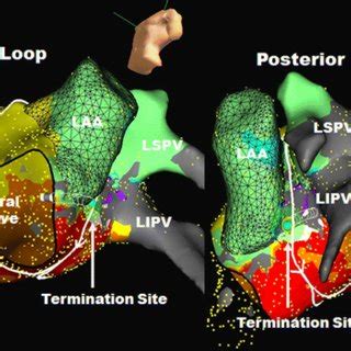 Complex Mitral Isthmus Flutter Much Of The Atrial Flutter Circuit Is Download Scientific