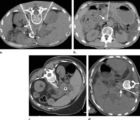 Patient Positions Used In Ct Guided Celiac Plexus Block A Axial Download Scientific Diagram