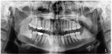 Supernumerary Numbering System