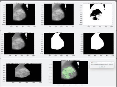 Figure 5 From Automated Breast Density Assessment Using Image Processing Techniques Semantic