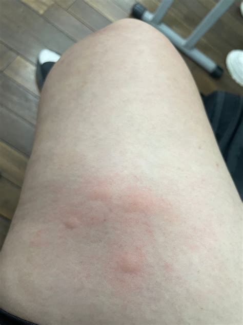 알레르기 인가요 벌레물린곤가요 지식in