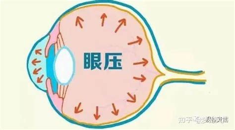 都知道三高危害大可你知道眼压高会怎么样吗 知乎