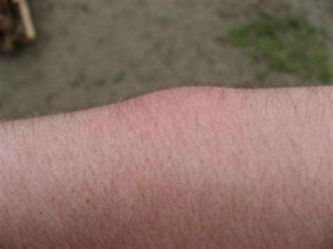 Mosquito Bite Rash Causes And Treatment Pestseek