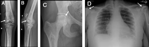 Imaging Of Musculoskeletal Manifestations In Sickle Cell Disease