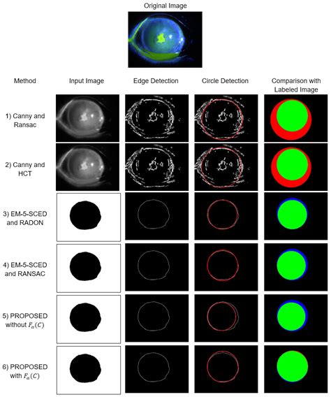 A Segmentation Based Automated Corneal Ulcer Grading System For Ocular Staining Images Using