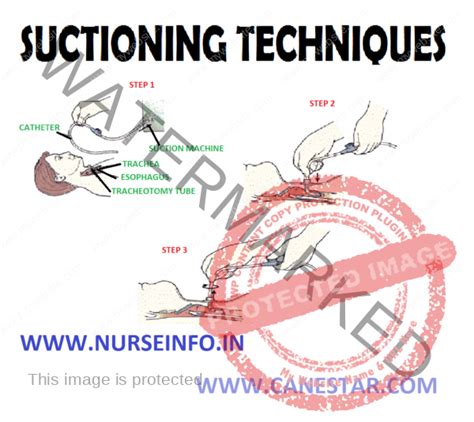 Suctioning Technique Nurse Info
