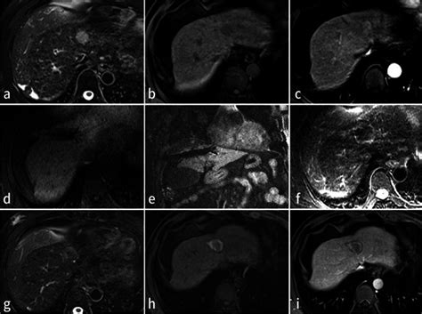 Refining Mr Guided Thermal Ablation For Hcc Within The Milan Criteria A Decade Of Clinical