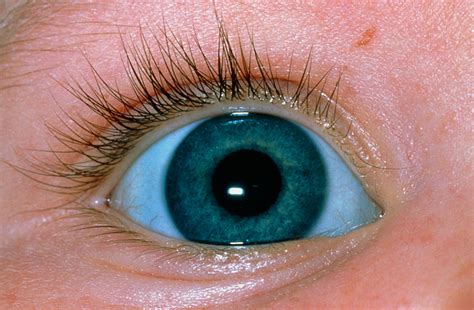 Sclera Disorders