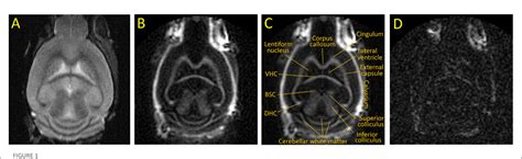 Figure 1 From 3d Inversion Recovery Ultrashort Echo Time Mri Can Detect