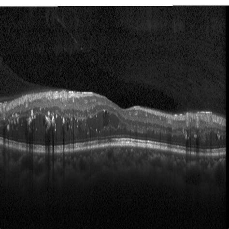 Macular Edema Object Detection Dataset By Macular Edema