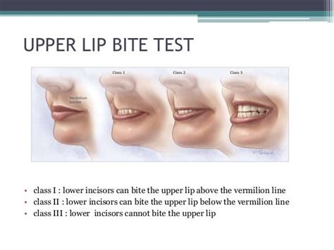 Upper Lip Bite Test Anterior Crossbite Treatment With Clear Aligners