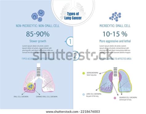 Types Lung Cancer Nonsmall Cell Small Stock Vector Royalty Free