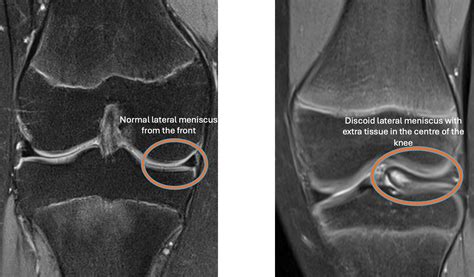 Discoid Meniscus — Chinmay Gupte