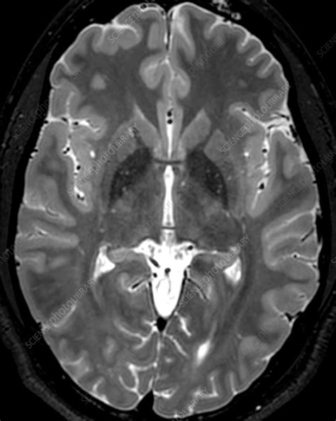 Normal Axial T2 Brain Stock Image C0393778 Science Photo Library