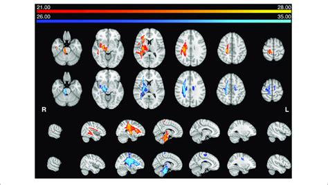 Structural Disconnection Frequency Map 75 Voxels Of White Matter Download Scientific