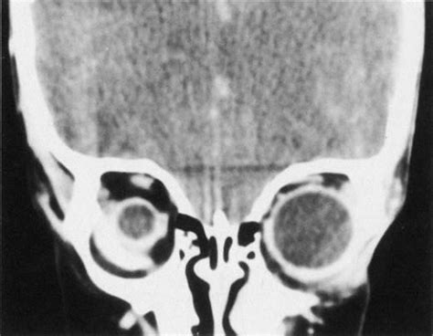 Congenital And Developmental Anomalies Of The Orbit Ento Key