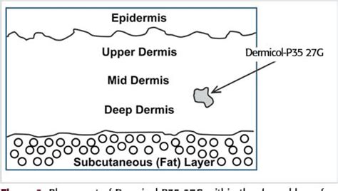 Pdf Cheek Augmentation With Dermicol P35 27g Semantic Scholar