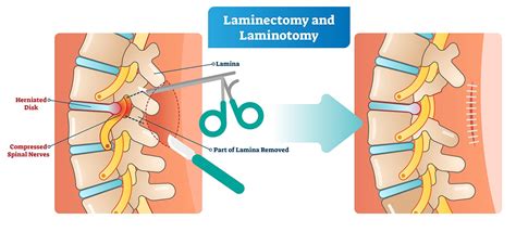 Laminectomy Fusion Vs Laminoplasty Cervical Spine
