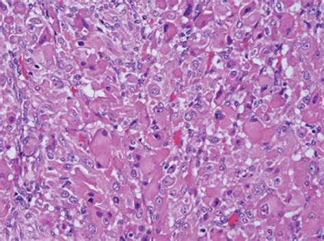 Botryoid Rhabdomyosarcoma Of The Cervix A Systematic Review Of The Literature From 1937 To 2017