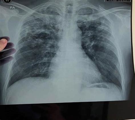 Chest X Ray Showed Infiltrates In Both Lungs Particularly On The Download Scientific Diagram