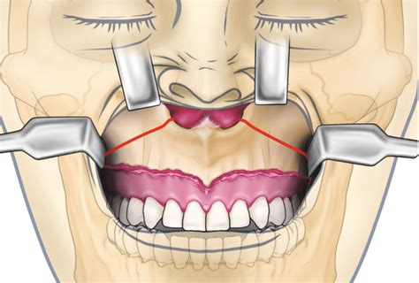 The Le Fort I Osteotomy Stepwise Procedure Springerlink