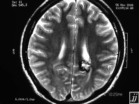 Cavernoma Radiopaedia