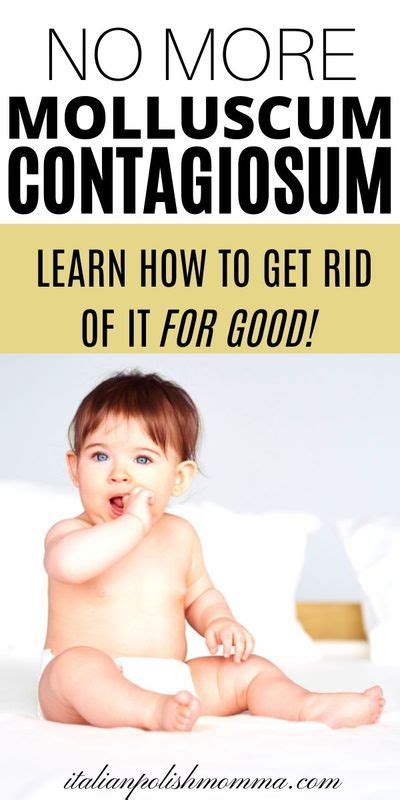 Best 12 6 Home Remedies For Molluscum Contagiosum And How To Use Them