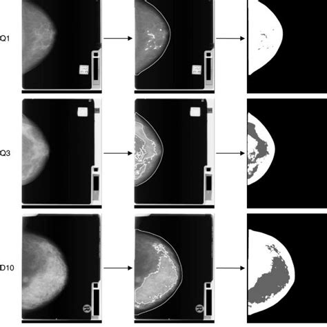 Examples Of The Autodensity Breast Density Segmentation Process On Download Scientific Diagram
