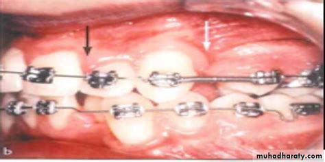 Ortho Perio Problem Pptx دنعم رياض Muhadharaty
