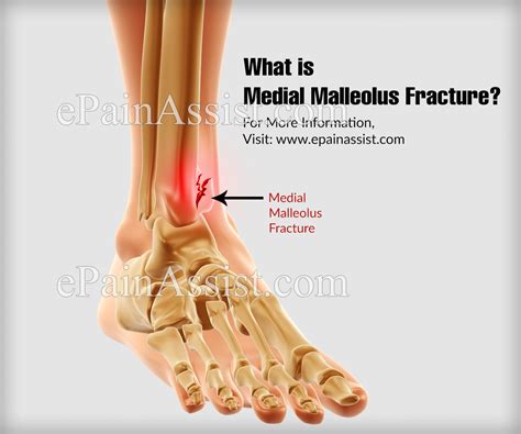 Medial Malleolus Fracture Causes Symptoms Treatment Recovery Time Diagnosis