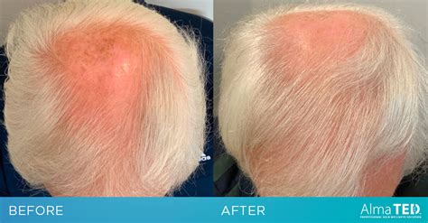 Hair Restoration Before And After Treatment Photos