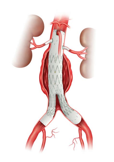 Abdominal Aortic Aneurysm Aaa Vascular Care Wa
