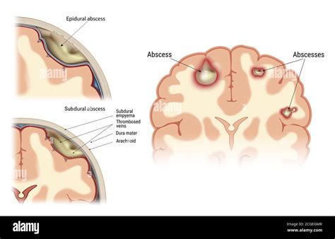 Abscess Set Vector Stock Vector Image And Art Alamy