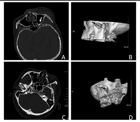 Figure 2 From Comparison Of Efficacy And Safety Of Ct Guided Radiofrequency Thermocoagulation