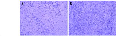 Histology Of Cholangiocarcinoma With Stem Cell Features A Download Scientific Diagram