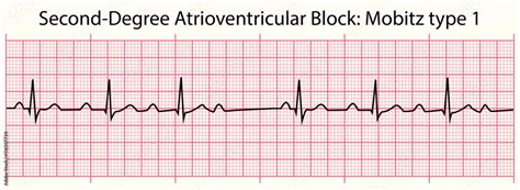 Vetor De Ecg Line Second Degree Atrioventricular Block Mobitz Type 1 In 6 Second Ecg Paper