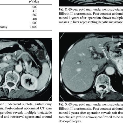 Time And Modes Of Recurrence For Early Gastric Cancer Download