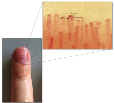 A Capillaroscopy Based Method To Help Prediction Of Systemic Sclerosis