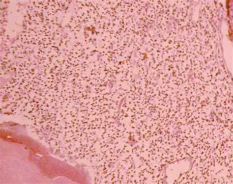 Severe Inflammation 2 Months After Pulpotomy With Formocresol H And E×40 Download Scientific
