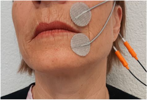Emg Triggered Functional Electrical Stimulation For Central Facial