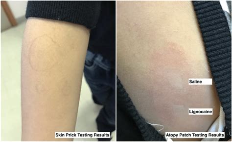 Negative Immediate Reading Epicutaneous Prick And Intradermal Skin Download Scientific Diagram