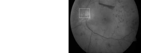 4 Neovascularization Marked Region Download Scientific Diagram