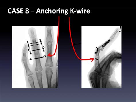 Case 8 Pip Flexion Contracture After Replantation Virak Orthopedics