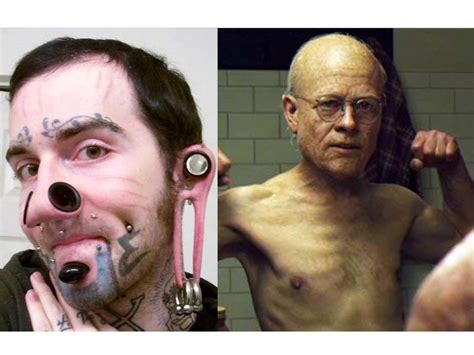 Benjamin Button Disease