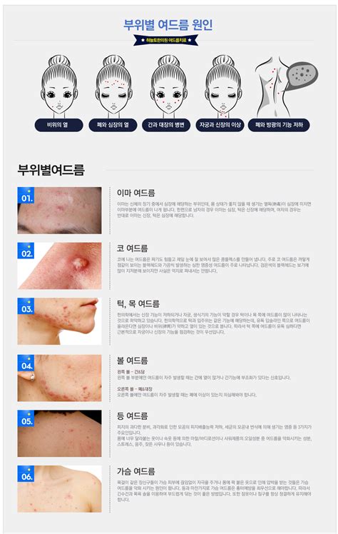 하늘토한의원 수원점 여드름치료 부위별여드름