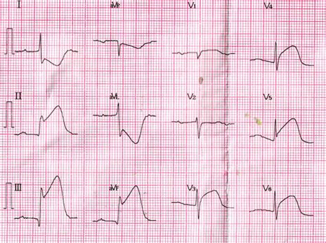 Initial Electrocardiogram Shown Is St Segment Elevation In The