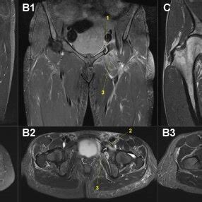 Mobile Mri Of Pelvis Region And Hip Joints A Male 45 Years Old