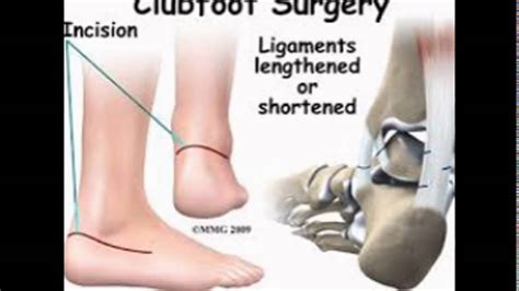 Cleft Foot Surgerycleft Foot Treatmentcleft Foot Deformitycleft Foot