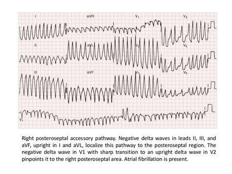 Localization Of Wpw Accessory Pathway By Surface Ecg
