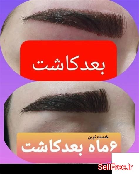 کاشت مو سر و ابرو تخصصی در اردبیل اردبیل خرید و فروش رایگان